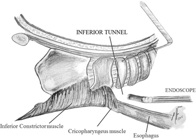 Transoral ultrasonic total laryngectomy (TOUSS-TL): description of a ...