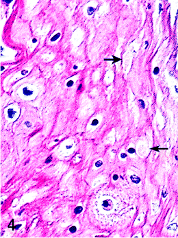 Pustular rumenitis associated with epithelial akeratosis, dyskeratosis ...