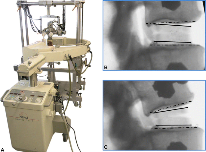 Two-piece ALIF cage optimizes the bone–implant interface in a 360 ...