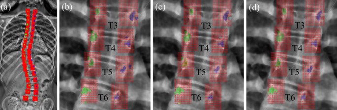 Vertebral rotation estimation from frontal X-rays using a quasi ...