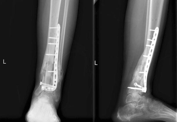 Surgical management of pilon fractures with large segmental bone ...