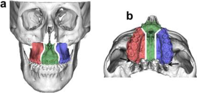 Randomized clinical trial of surgically assisted rapid maxillary ...