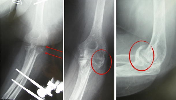 Hinged external fixation for Regan–Morrey type I and II fractures and ...
