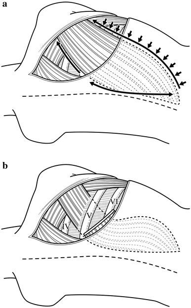 Esophagectomy and combined lobectomy with a covering latissimus dorsi ...