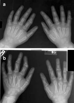 Multiple osteochondroma of the hand: initial and long-term follow-up ...