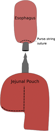 Prophylactic Laparoscopic Total Gastrectomy with Jejunal Pouch ...
