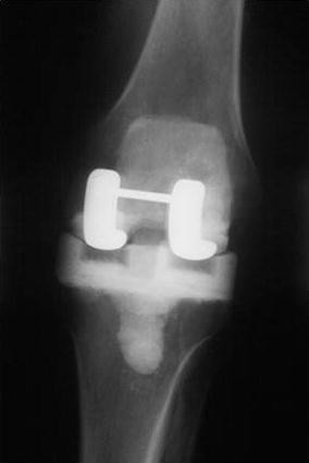 Durable Infection Control and Function With the PROSTALAC Spacer in Two ...