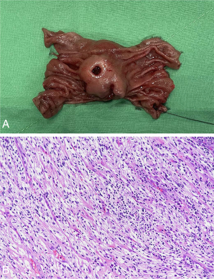 Segmental Duodenal Resection for Gastrointestinal Stromal Tumor ...