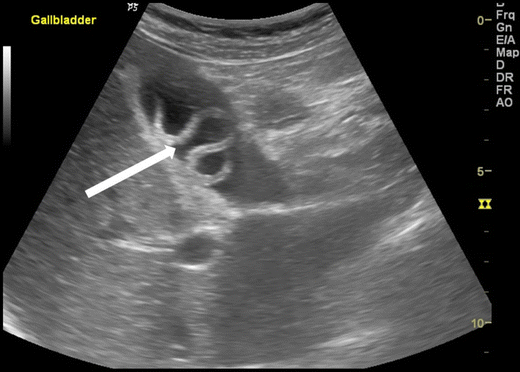 Sonographic images of hepato-pancreatico-biliary and intestinal ...