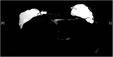 Magnetic resonance imaging of breast augmentation: a pictorial review ...
