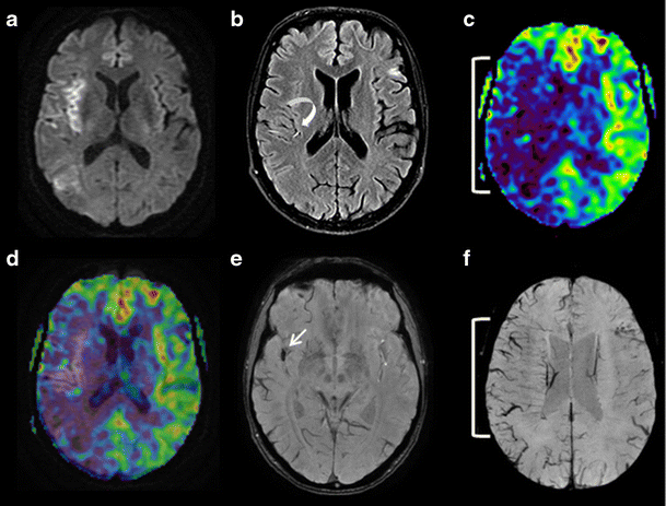 ASL and susceptibility-weighted imaging contribution to the management ...