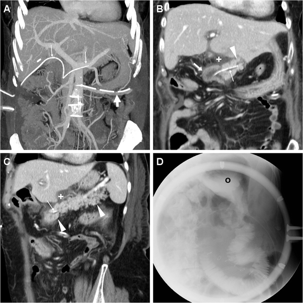 Elucidating early CT after pancreatico-duodenectomy: a primer for ...