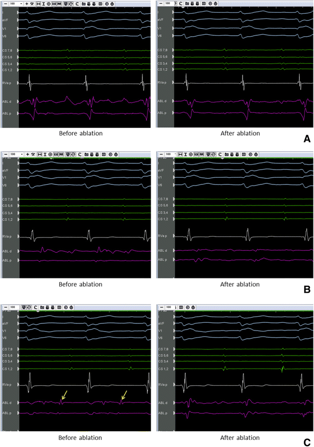 Combined Right Ventricular Outflow Tract Epicardial and Endocardial ...