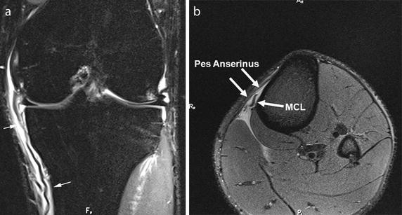 MRI of the Knee: What Do We Miss? | SpringerLink
