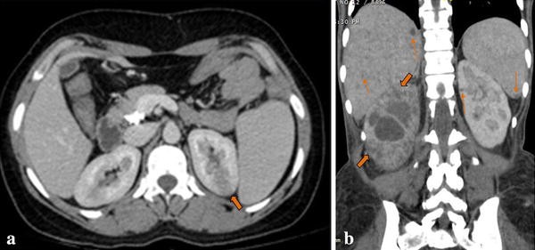 Multidetector CT in Renal Tuberculosis | SpringerLink