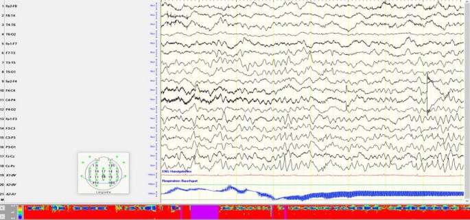 53/w mit Vigilanzminderung und linksbetonter Tetraparese mit Verdacht ...