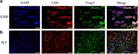 CALCB splice region pathogenic variants leading to plasma cell ...