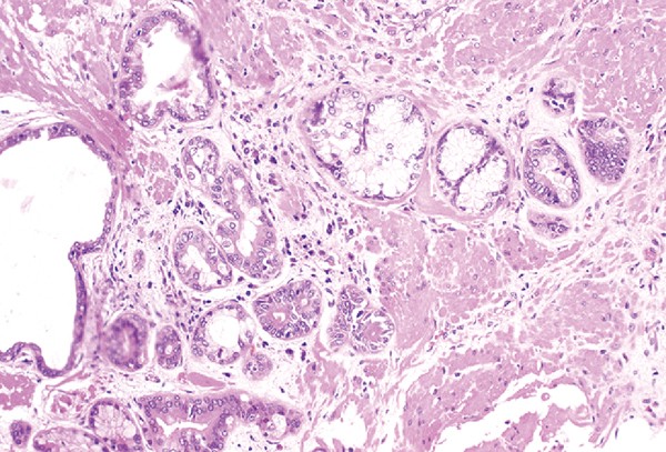 Benign mimickers of prostatic adenocarcinoma | Modern Pathology