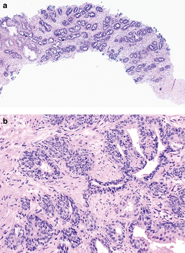 Benign mimickers of prostatic adenocarcinoma | Modern Pathology
