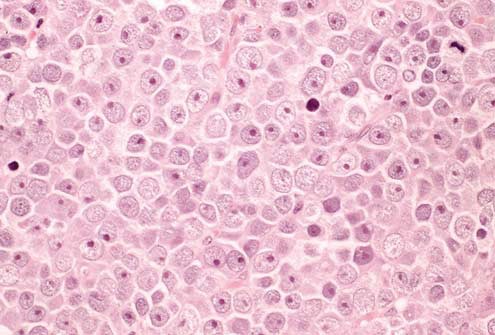 Germ cell tumors of the gonads: a selective review emphasizing problems ...