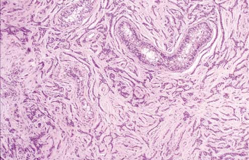 Sex cord-stromal tumors of the ovary and testis: their similarities and ...