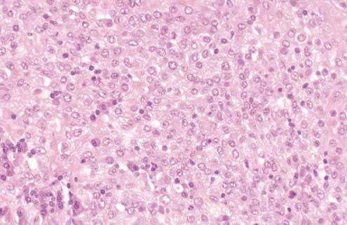 Sex cord-stromal tumors of the ovary and testis: their similarities and ...