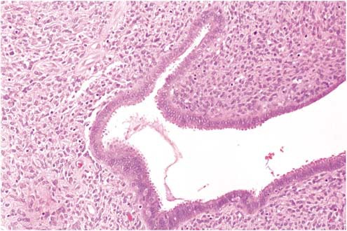 Selected miscellaneous ovarian lesions: small cell carcinomas ...