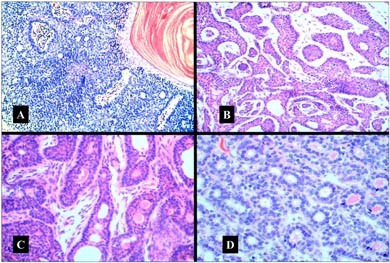 Salivary Gland Neoplasia: A Review for the Practicing Pathologist ...