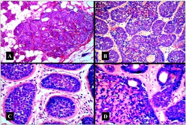 Salivary Gland Neoplasia: A Review for the Practicing Pathologist ...