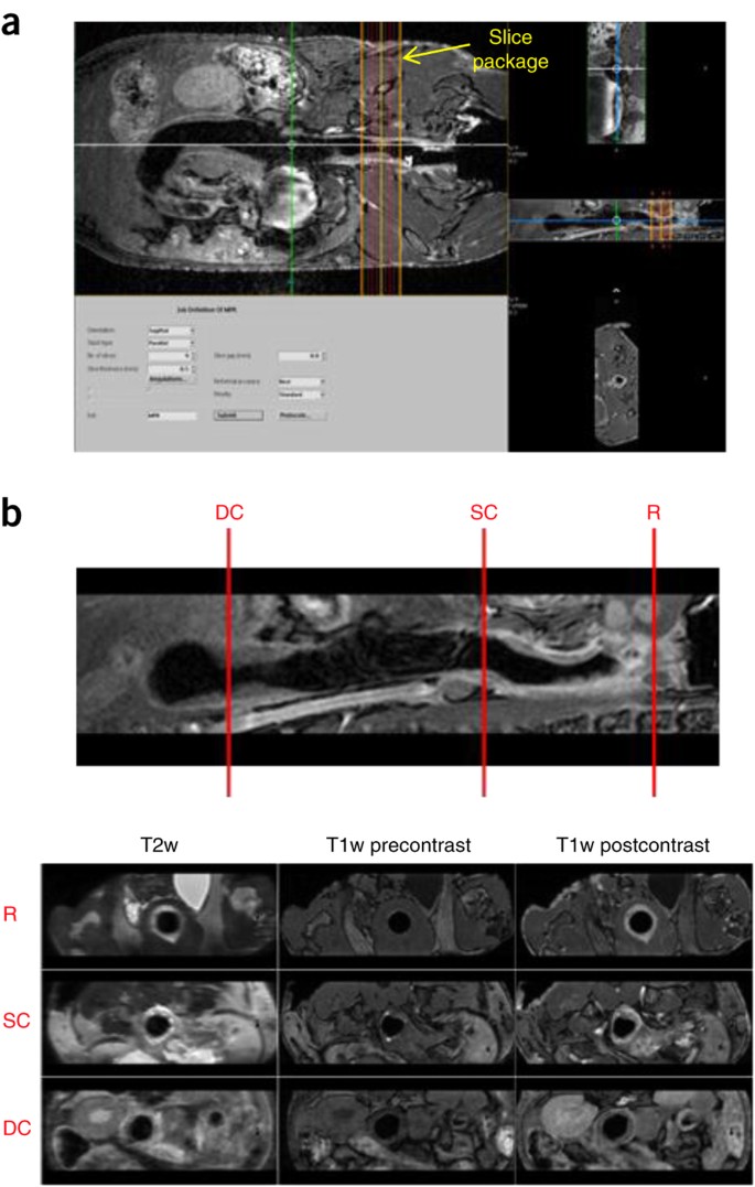 In vivo MRI virtual colonography in a mouse model of colon cancer ...