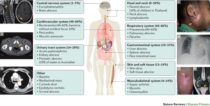 Melioidosis | Nature Reviews Disease Primers