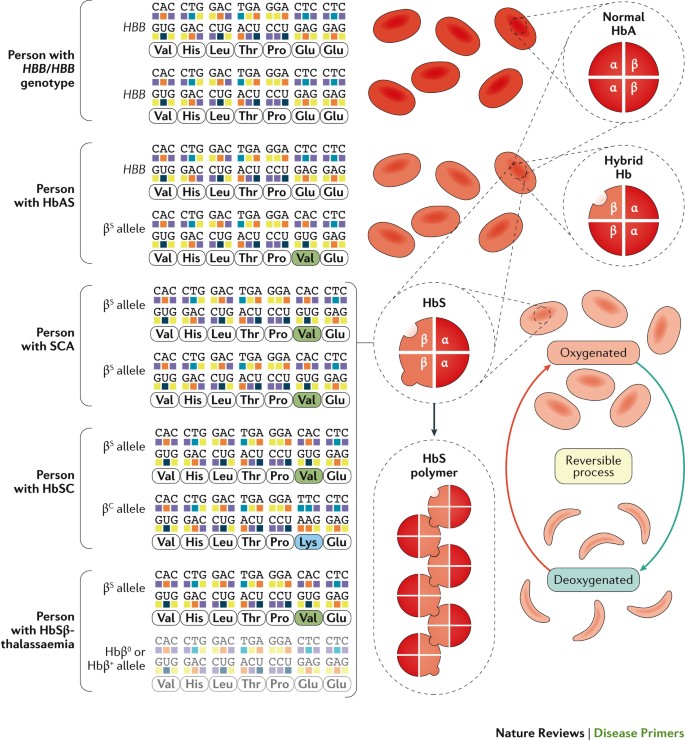 Sickle cell disease | Nature Reviews Disease Primers