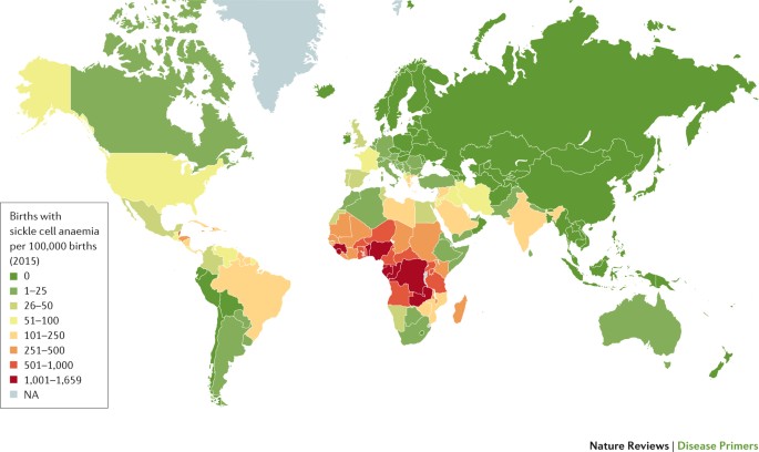 Sickle cell disease | Nature Reviews Disease Primers