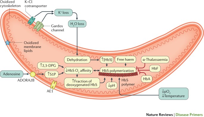 Sickle cell disease | Nature Reviews Disease Primers