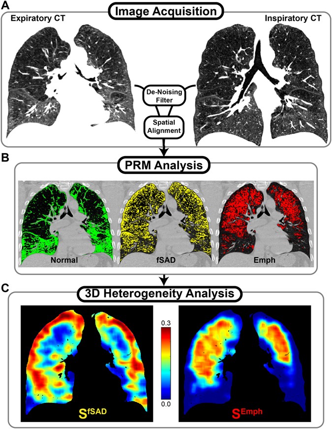 CT-Based Local Distribution Metric Improves Characterization of COPD ...
