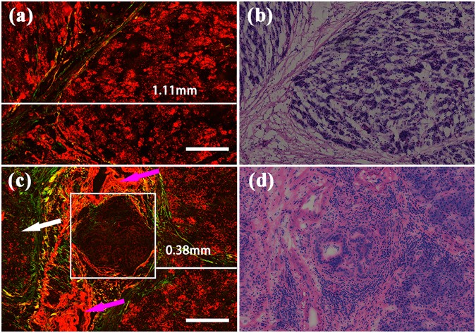 Identifying the neck margin status of ductal adenocarcinoma in the ...