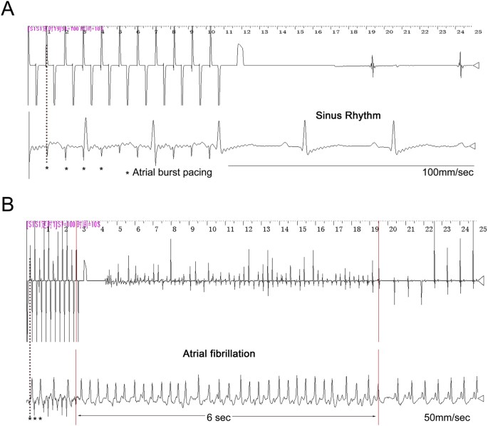 Metoprolol prevents chronic obstructive sleep apnea-induced atrial ...