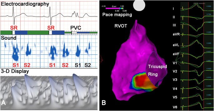 Predicting the Origin of Ventricular Arrhythmia Using Acoustic ...