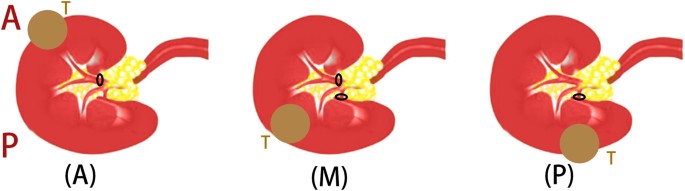 The C.L.A.M.P. Nephrometry score: A system for preoperative assessment ...