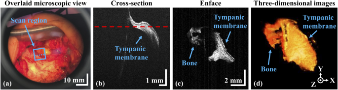 Clinical Utility of Intraoperative Tympanomastoidectomy Assessment ...