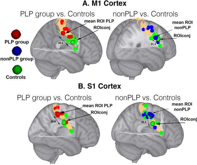 Assessment of cortical reorganization and preserved function in phantom ...