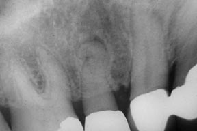 Endodontics: Part 2 Diagnosis and treatment planning | British Dental ...
