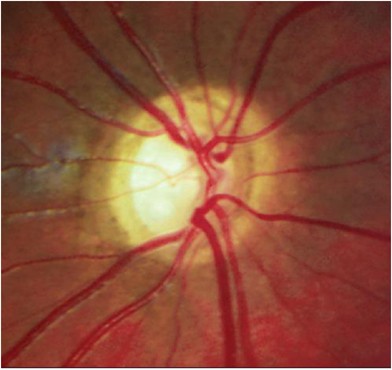 Optic nerve axons: life and death before birth | Eye