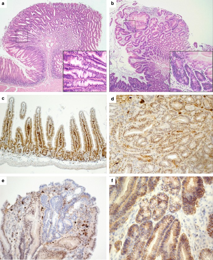 Smad4 haploinsufficiency in mouse models for intestinal cancer | Oncogene