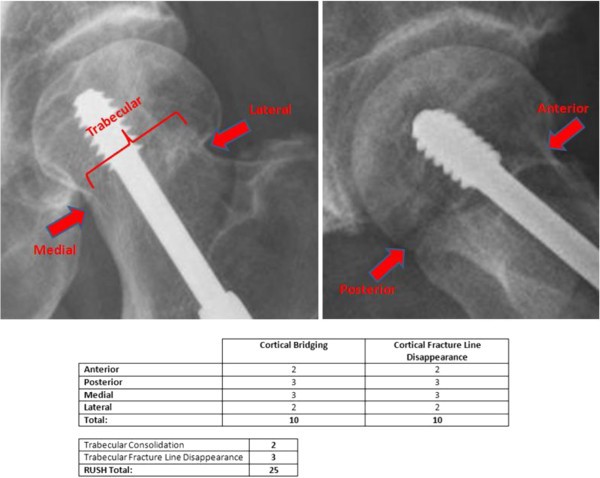 Radiographic union score for hip substantially improves agreement ...
