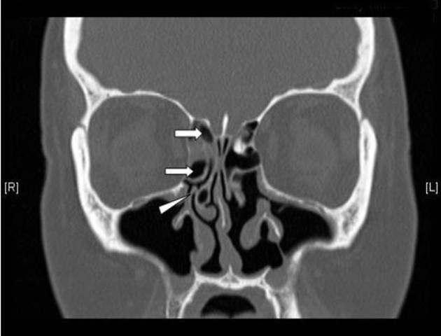 Radiological findings in patients undergoing revision endoscopic sinus ...