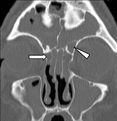 Radiological findings in patients undergoing revision endoscopic sinus ...
