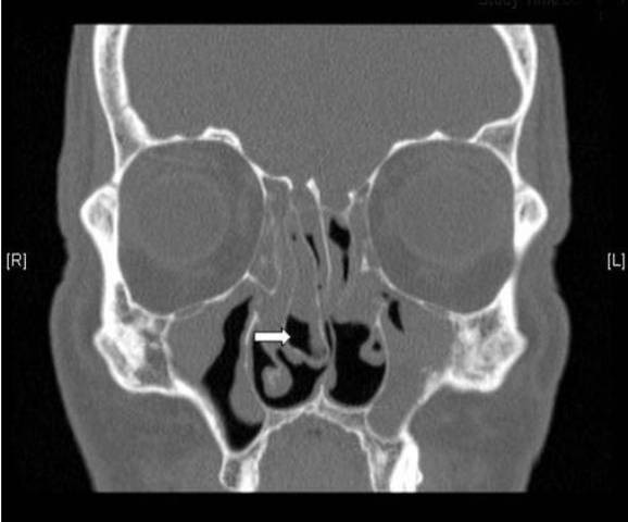 Radiological findings in patients undergoing revision endoscopic sinus ...