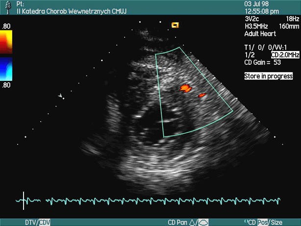 Imaging of all three coronary arteries by transthoracic ...