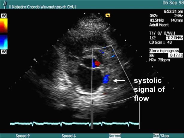 Imaging of all three coronary arteries by transthoracic ...